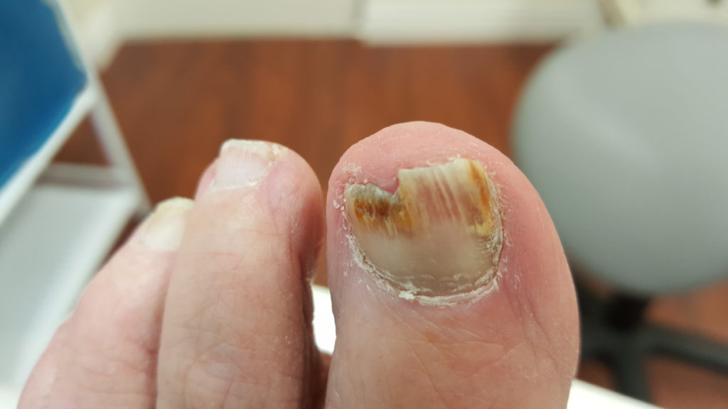 Fungal Toenail Infection Curse or Cure? - Reid Podiatry